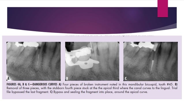 Management of fractured endodontic instruments in root canal | PPTX