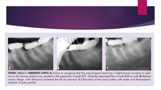 Management of fractured endodontic instruments in root canal | PPTX