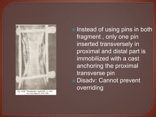 Management of fractures | PPTX