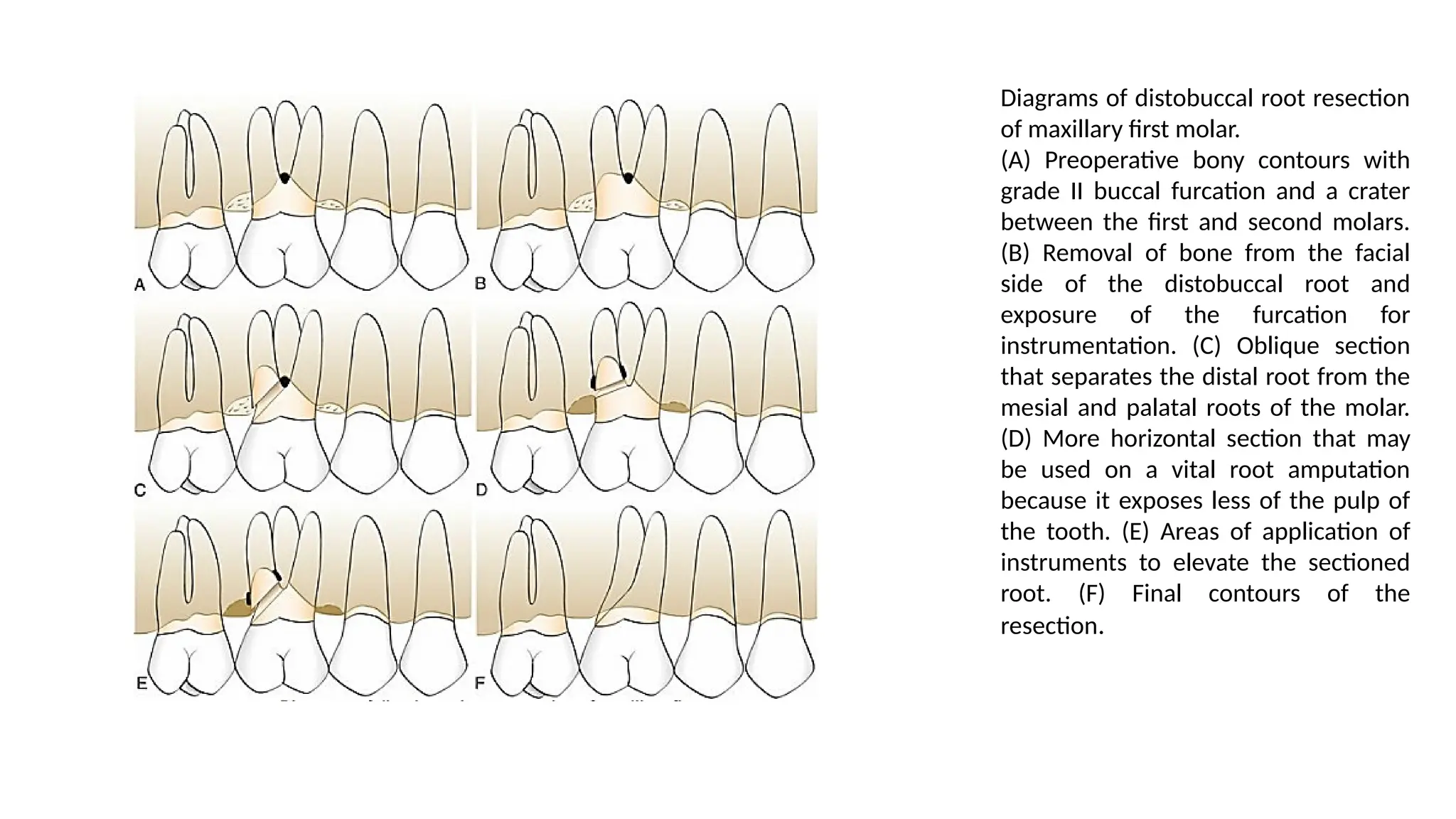 Management of Furcation defects. management of furcation defects | PPTX