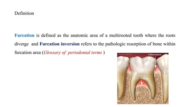 Management of Furcation defects. management of furcation defects | PPTX
