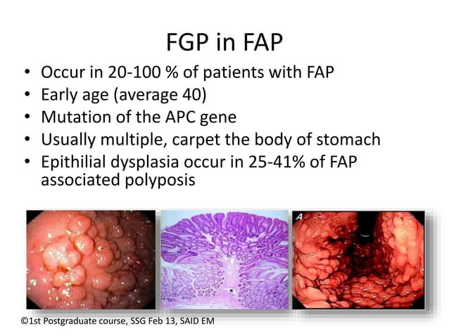 Management of gastric polyps | PPTX