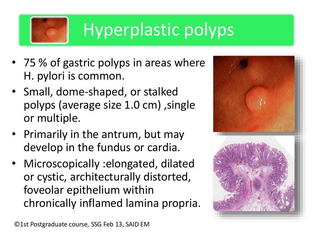 Management of gastric polyps