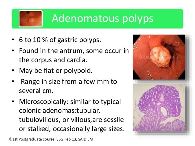 Management of gastric polyps