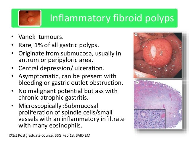 Management of gastric polyps