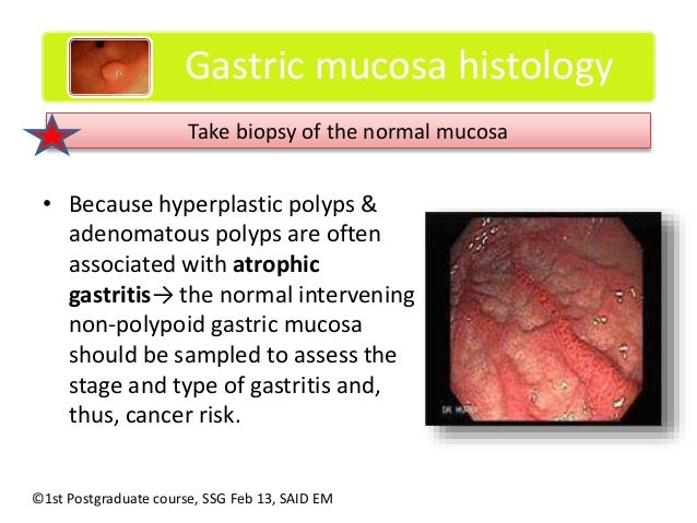 Management of gastric polyps