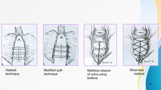 management of genital prolapse in cattle and buffalo by bhavesh devda.pptx