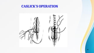 management of genital prolapse in cattle and buffalo by bhavesh devda.pptx