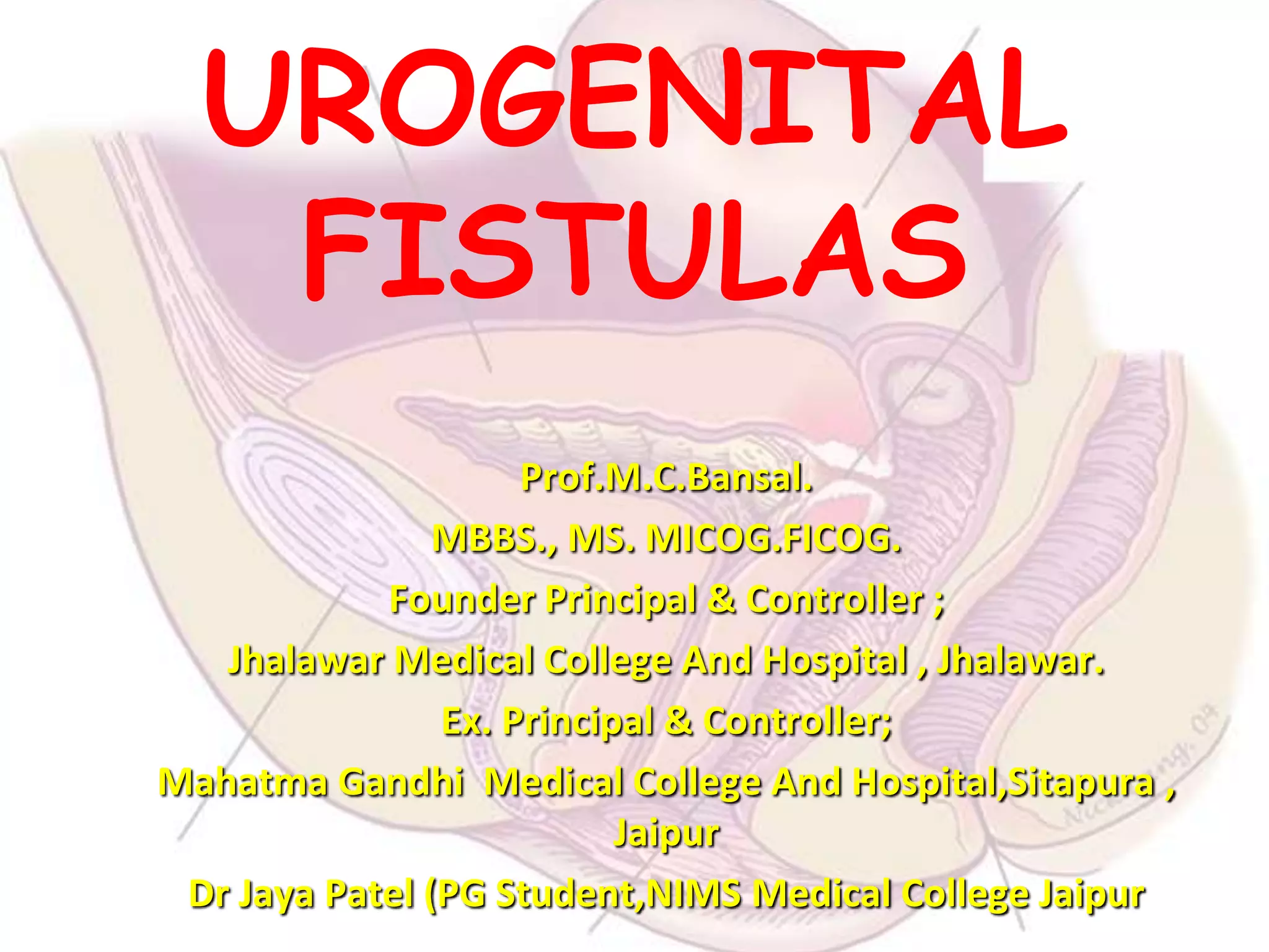 Management of genitourinary fistula | PPTX
