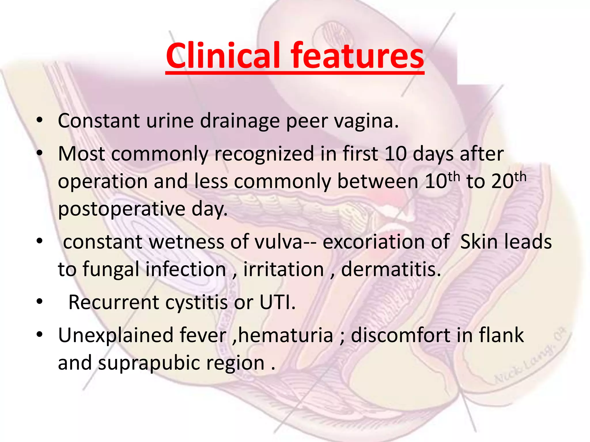 Management of genitourinary fistula | PPTX