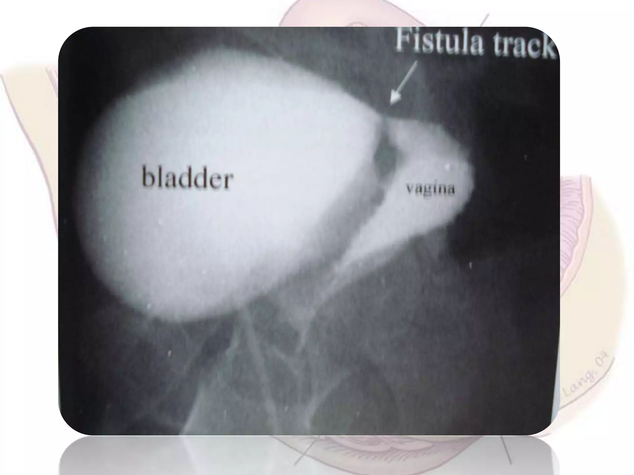 Management of genitourinary fistula | PPTX