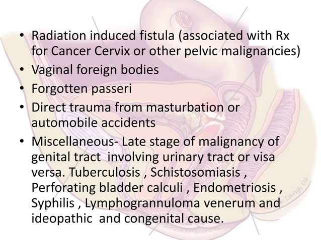 Management of genitourinary fistula | PPTX