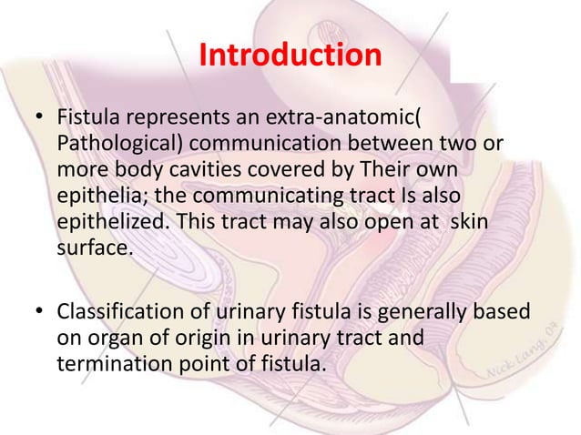 Management of genitourinary fistula | PPTX