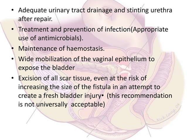 Management of genitourinary fistula | PPTX