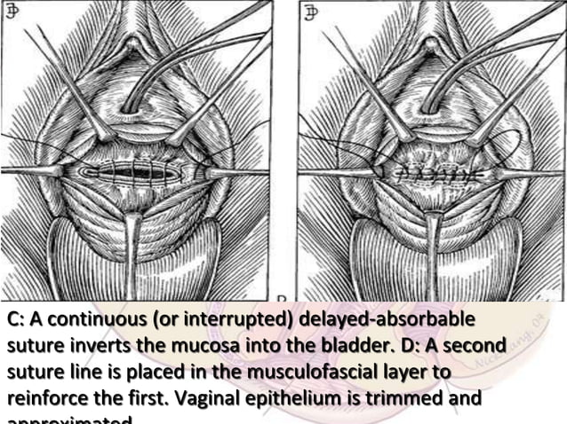 Management of genitourinary fistula | PPTX