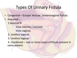 Ureterovaginal Fistula