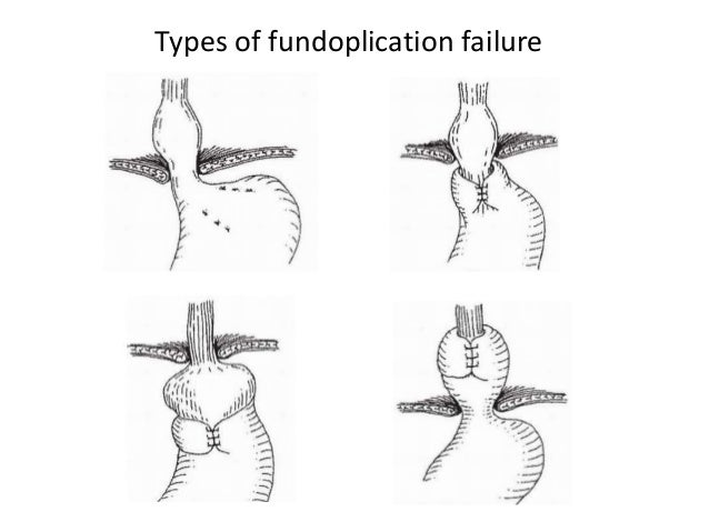 Management of Gastro-esophageal reflux disease