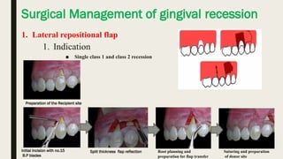 MANAGEMENT OF GINGIVAL RECESSION BY DR.HEMRAJ PANDIT.pptx