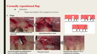 MANAGEMENT OF GINGIVAL RECESSION BY DR.HEMRAJ PANDIT.pptx