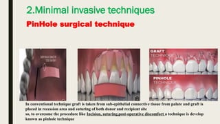 MANAGEMENT OF GINGIVAL RECESSION BY DR.HEMRAJ PANDIT.pptx