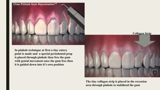 MANAGEMENT OF GINGIVAL RECESSION BY DR.HEMRAJ PANDIT.pptx