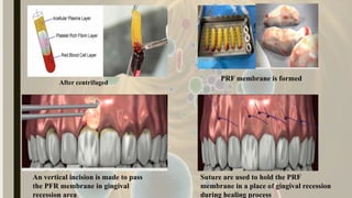 MANAGEMENT OF GINGIVAL RECESSION BY DR.HEMRAJ PANDIT.pptx