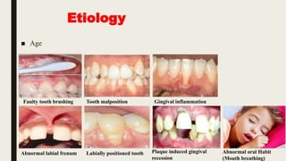 MANAGEMENT OF GINGIVAL RECESSION BY DR.HEMRAJ PANDIT.pptx