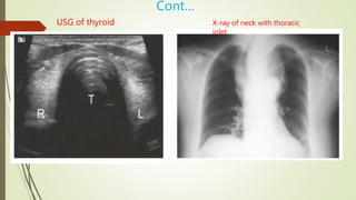 Management of goiter | PPTX