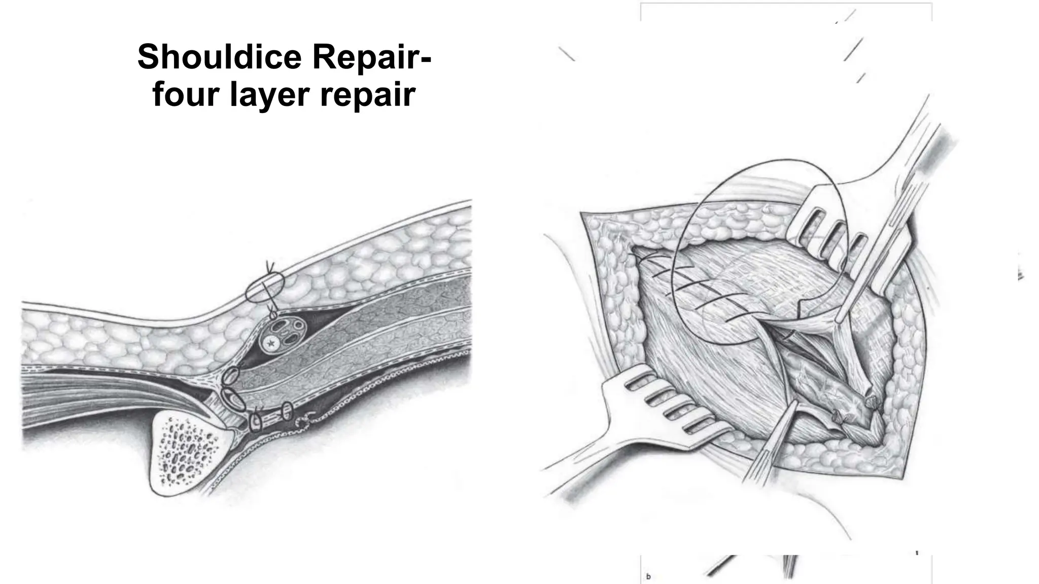 Management of Groin and Abdominal Wall Hernias.pptx
