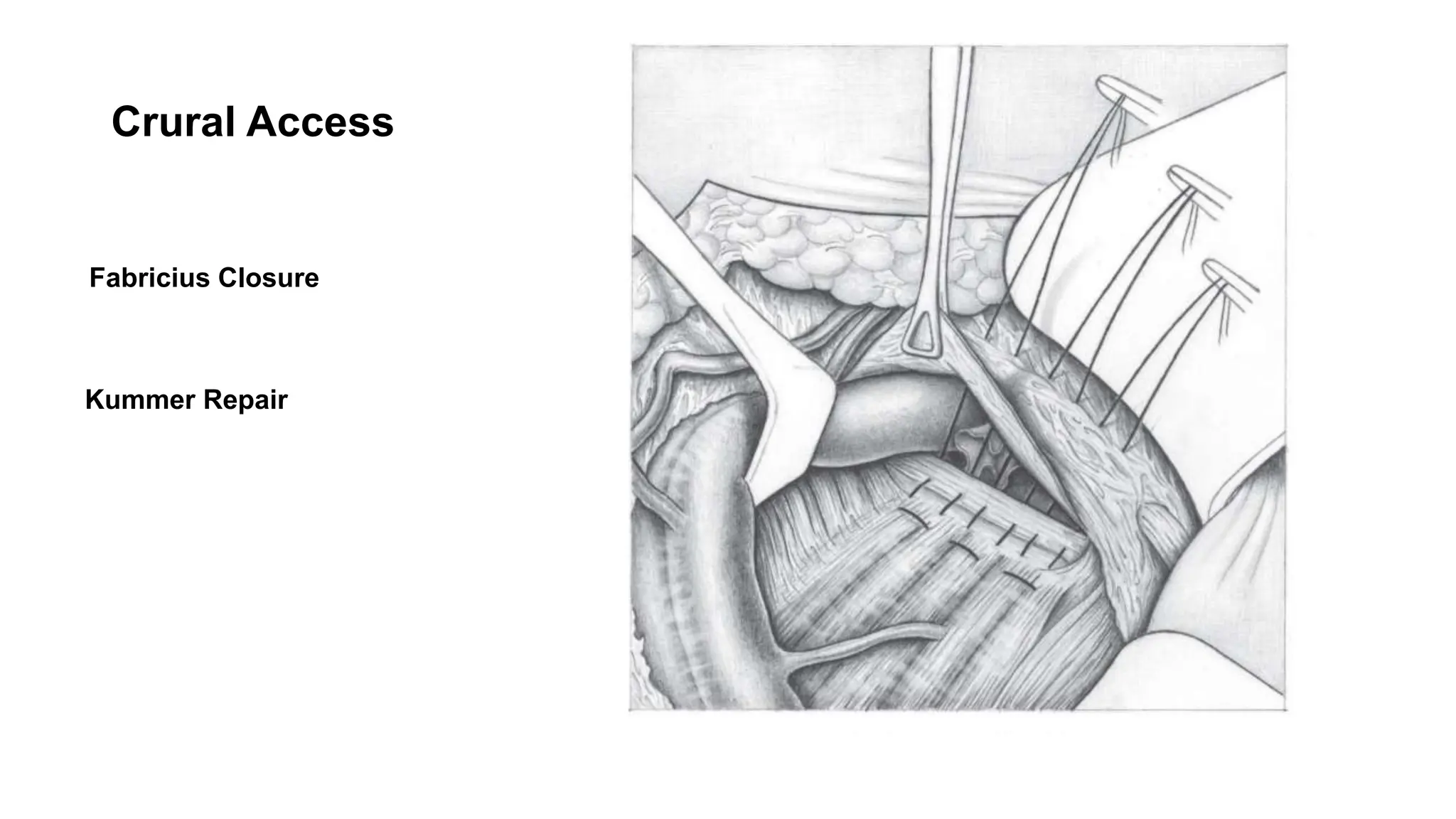 Management of Groin and Abdominal Wall Hernias.pptx