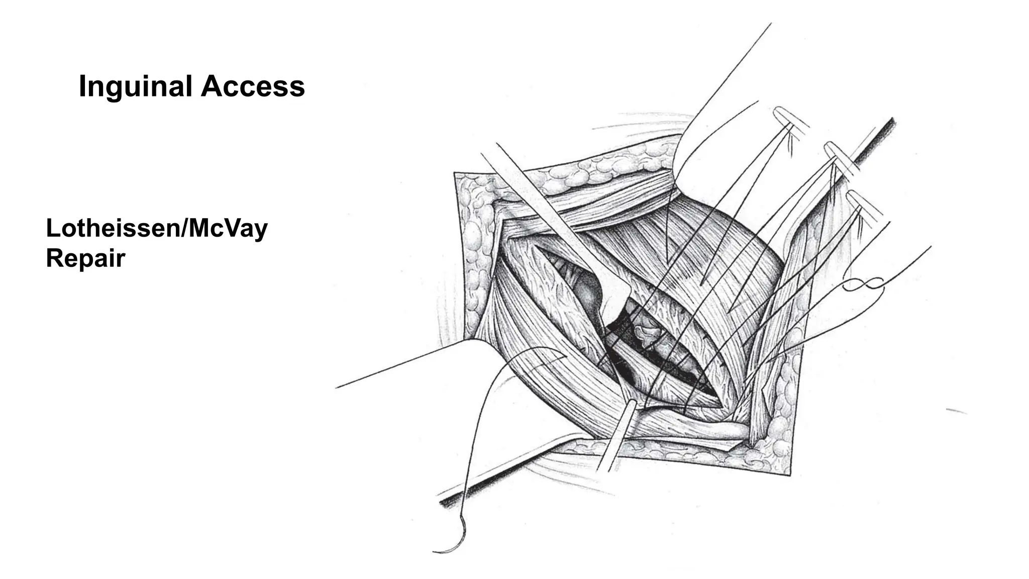 Management of Groin and Abdominal Wall Hernias.pptx