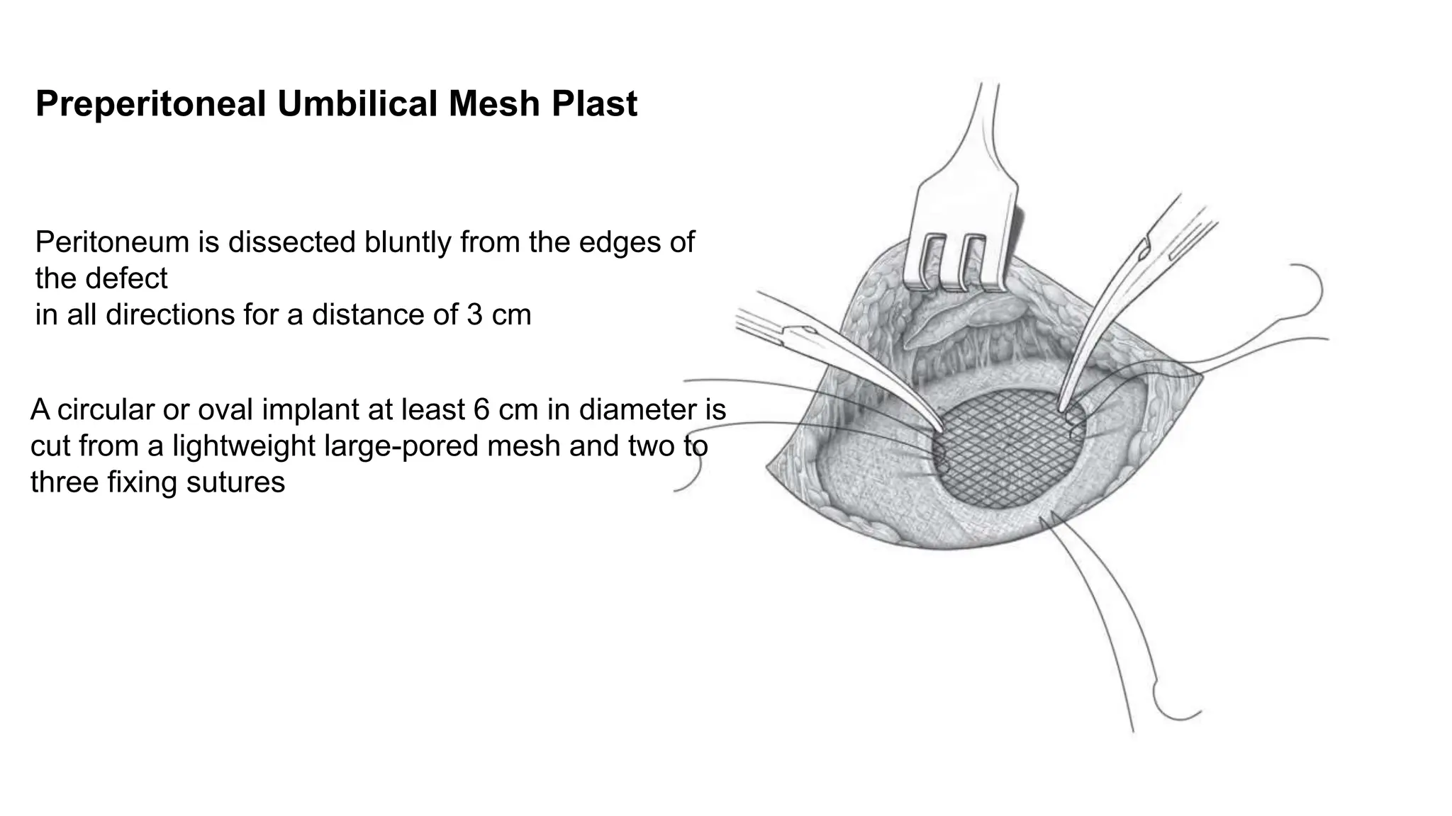 Management of Groin and Abdominal Wall Hernias.pptx