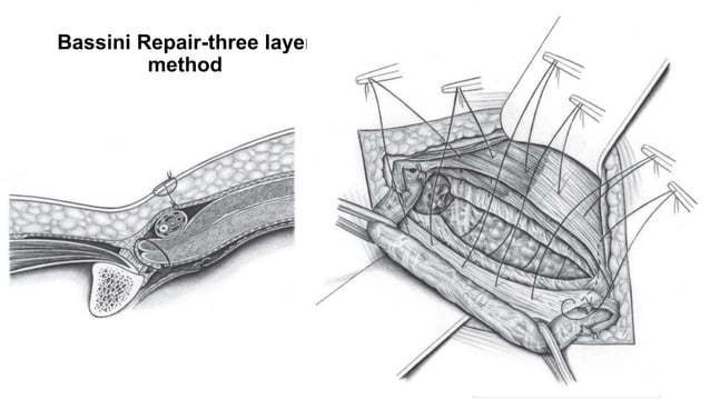 Management of Groin and Abdominal Wall Hernias.pptx | Digestive ...