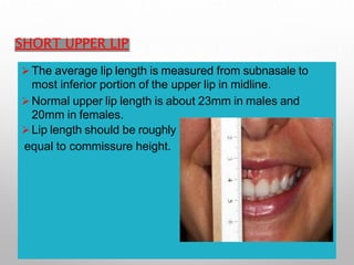MANAGEMENT OF GUMMY SMILE – A GOLDEN WAY.pptx