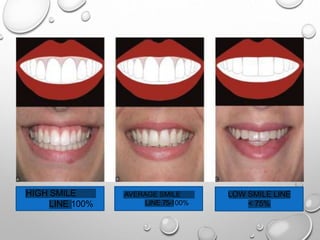 MANAGEMENT OF GUMMY SMILE – A GOLDEN WAY.pptx