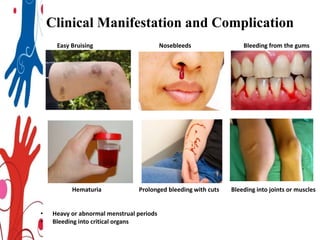 Management of haemophilia | PPTX