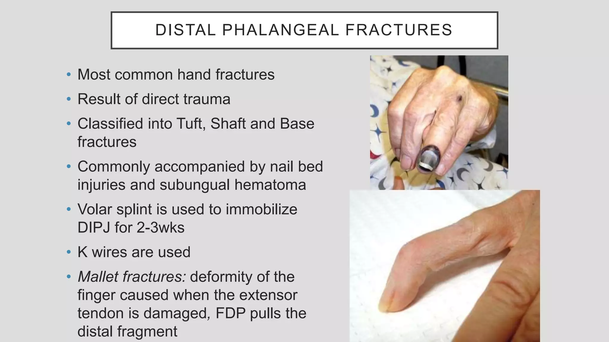 Management of hand and wrist fractures | PPTX