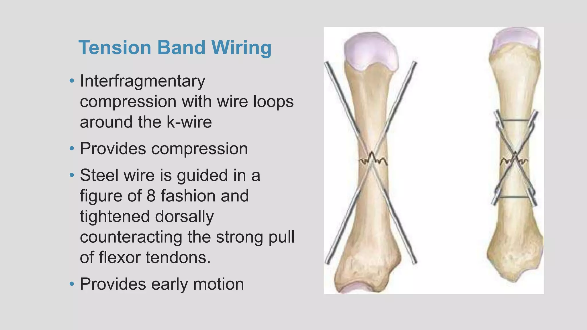 Management of hand and wrist fractures | PPTX