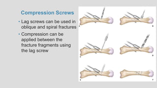 Management of hand and wrist fractures | PPTX