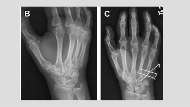 Bennett Fracture Treatment