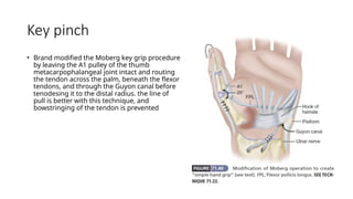MANAGEMENT OF HANDS IN TETRAPLEGICS.pptx