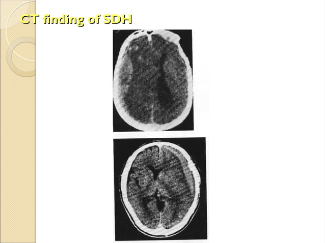 Management of head injury in surgical setting | PPT
