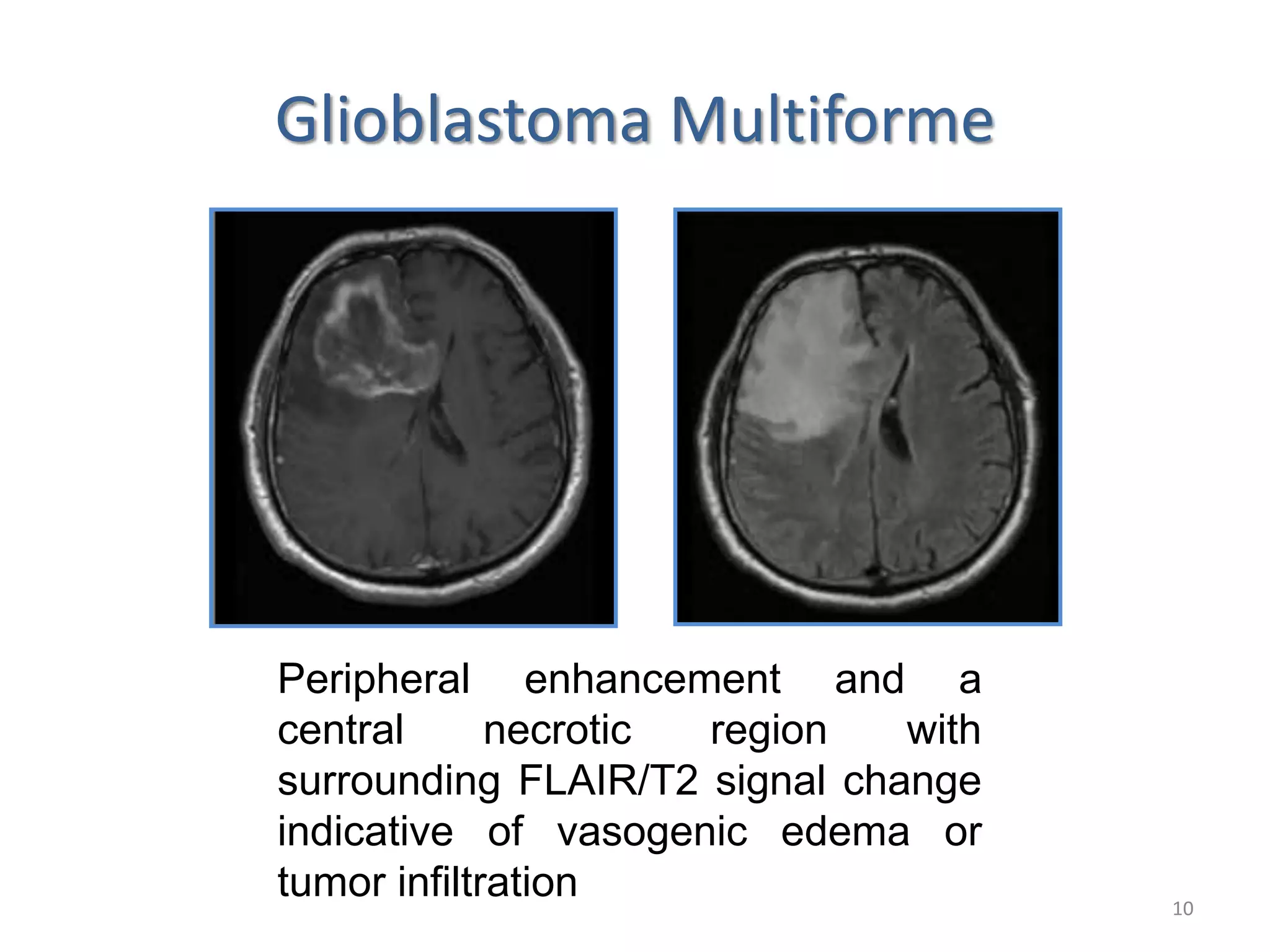 Management of high grade glioma | PPTX