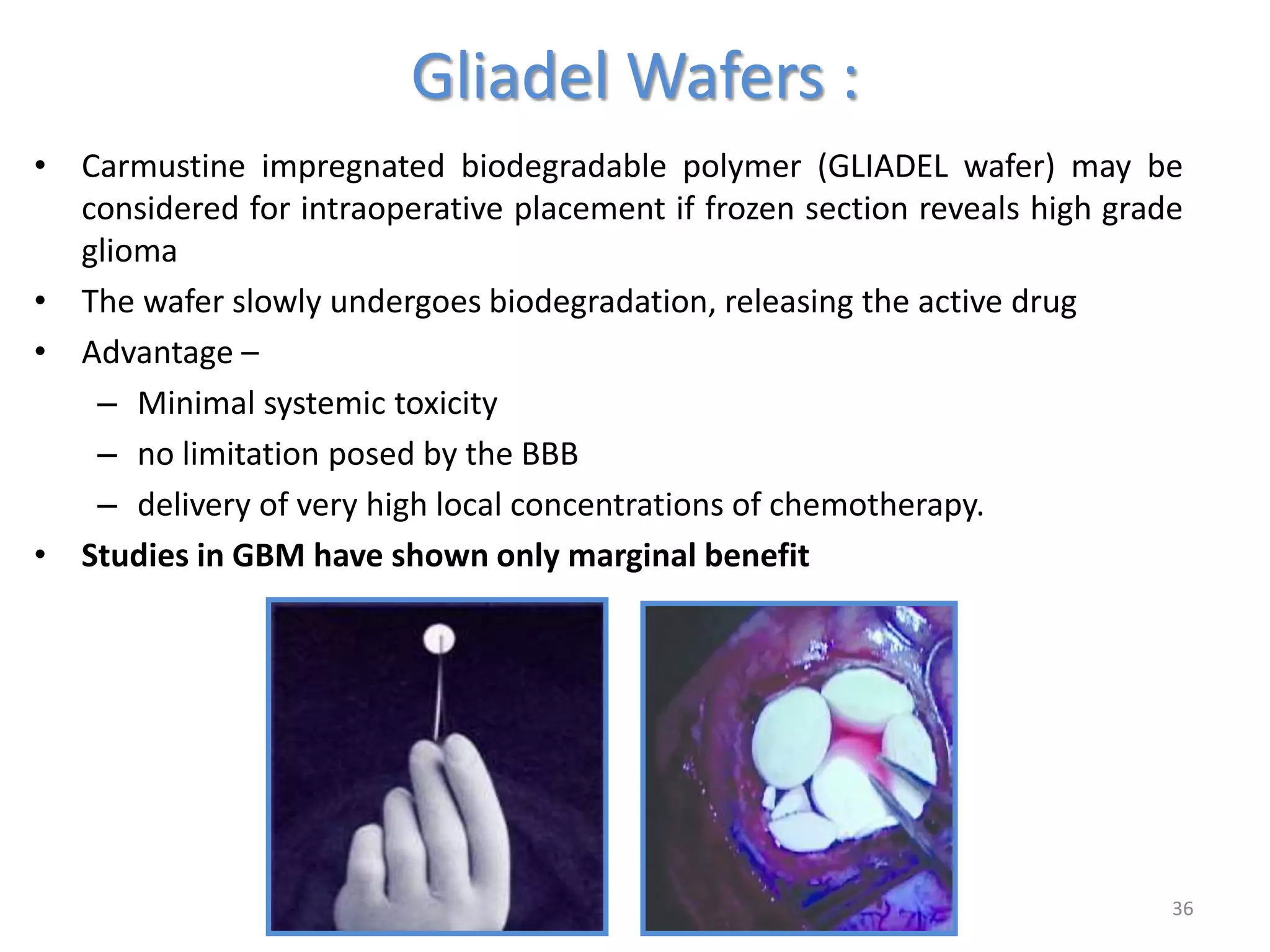 Management of high grade glioma | PPTX