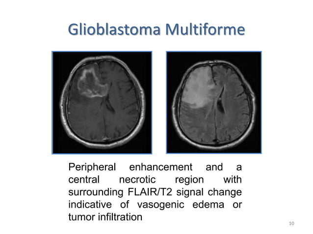 Management of high grade glioma | PPTX | Brain and Nervous System ...