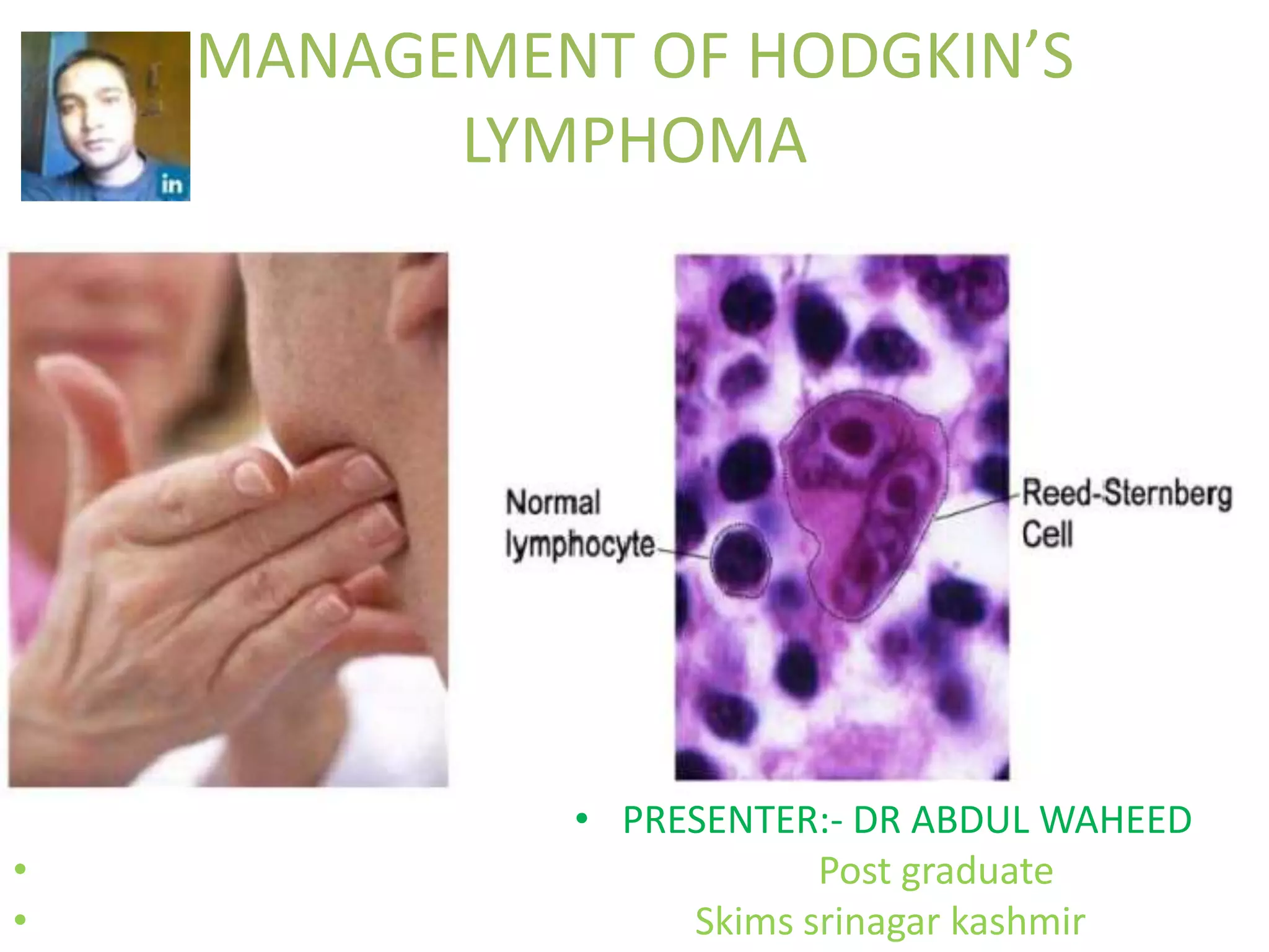 Management of hodgkin lymphoma.pptx123 | PPTX