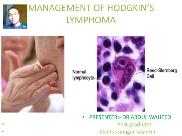 Management of hodgkin lymphoma.pptx123 | PPTX