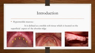 Management of hypermobile mucosa.pptx