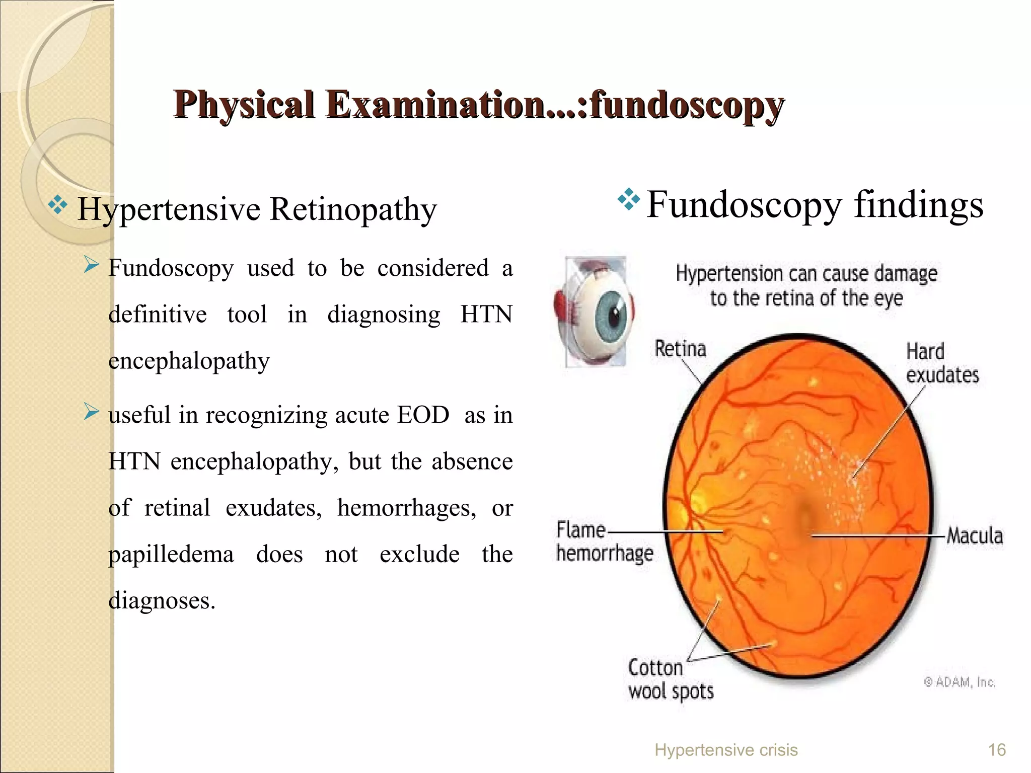 Management of hypertensive crisis | PPT