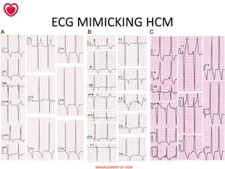 Management of hypertrophic cardiomyopathy | PPT